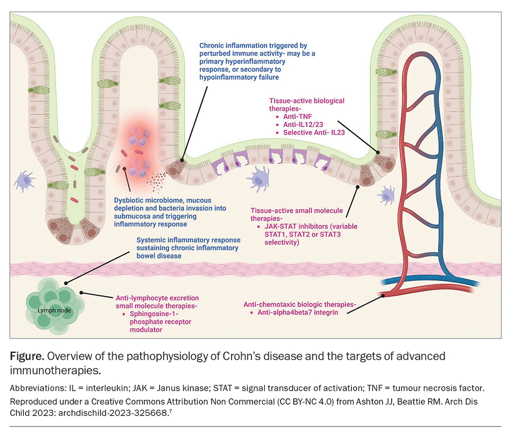 Crohn’s disease: an overview and update on medical and dietary therapies | Medicine Today